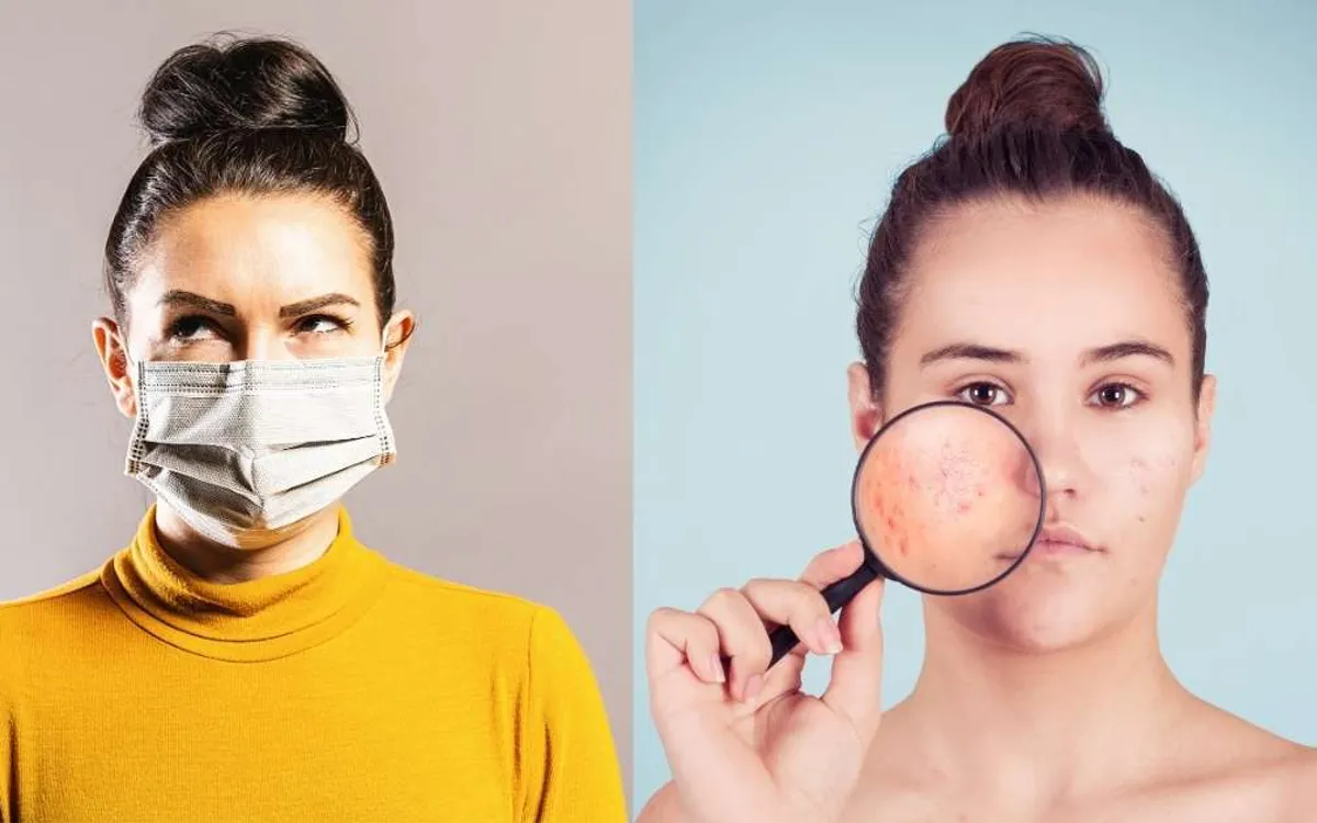 How to Treat Maskne | DocVita